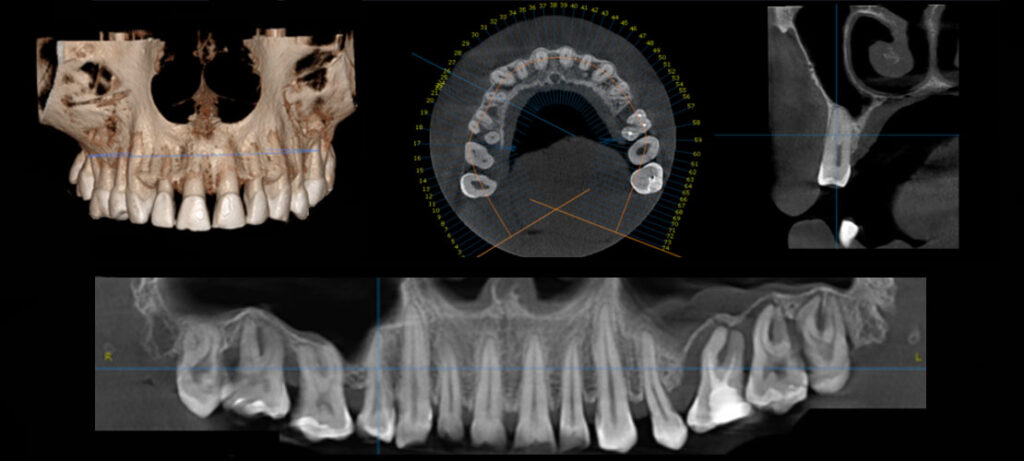 3D Maxilar - Centru de Radiologie Dentara R Dental