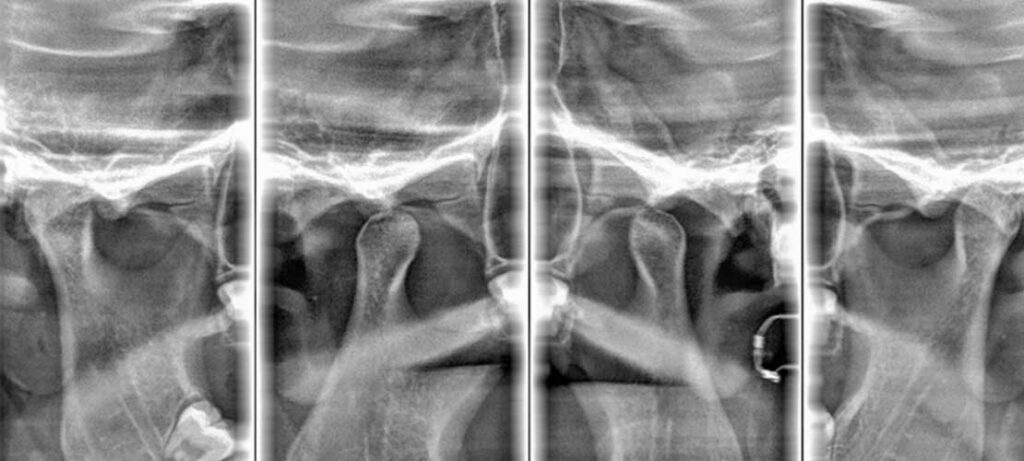 OPG ATM - Centru de Radiologie Dentara R Dental