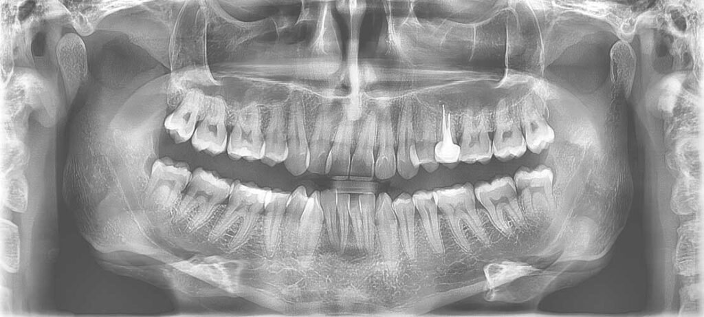 OPG Standard - Centru de Radiologie Dentara R Dental